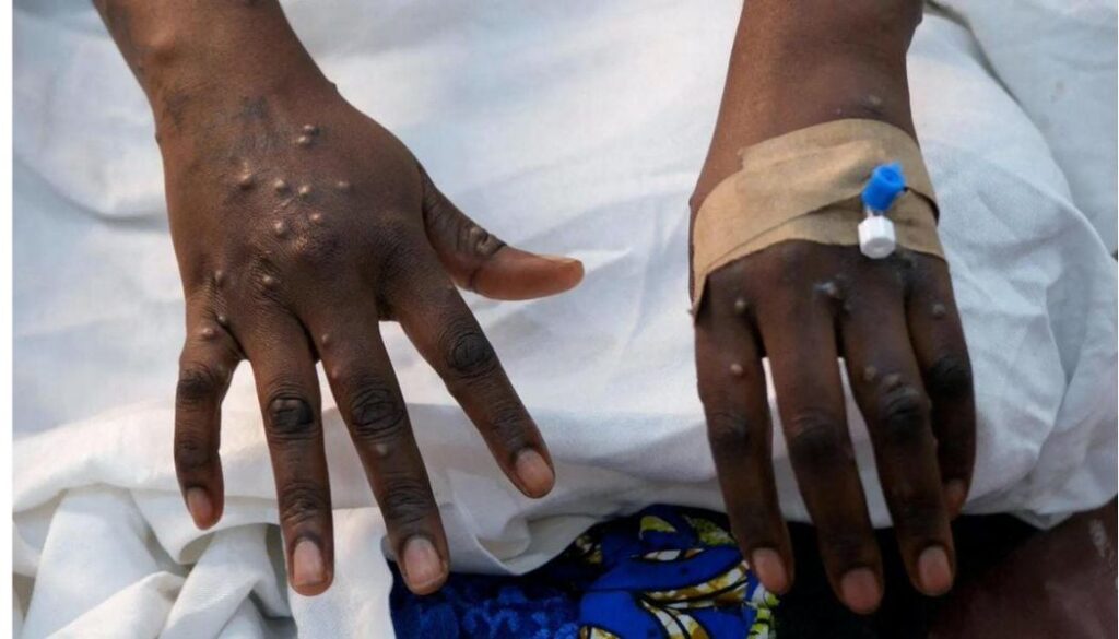 Gov’t Issues Alert Following Outbreak of Marburg Virus in South Ethiopia